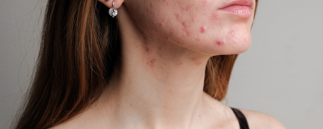 Understanding Adult Acne: Causes and Prevention Tips - Southlake ...