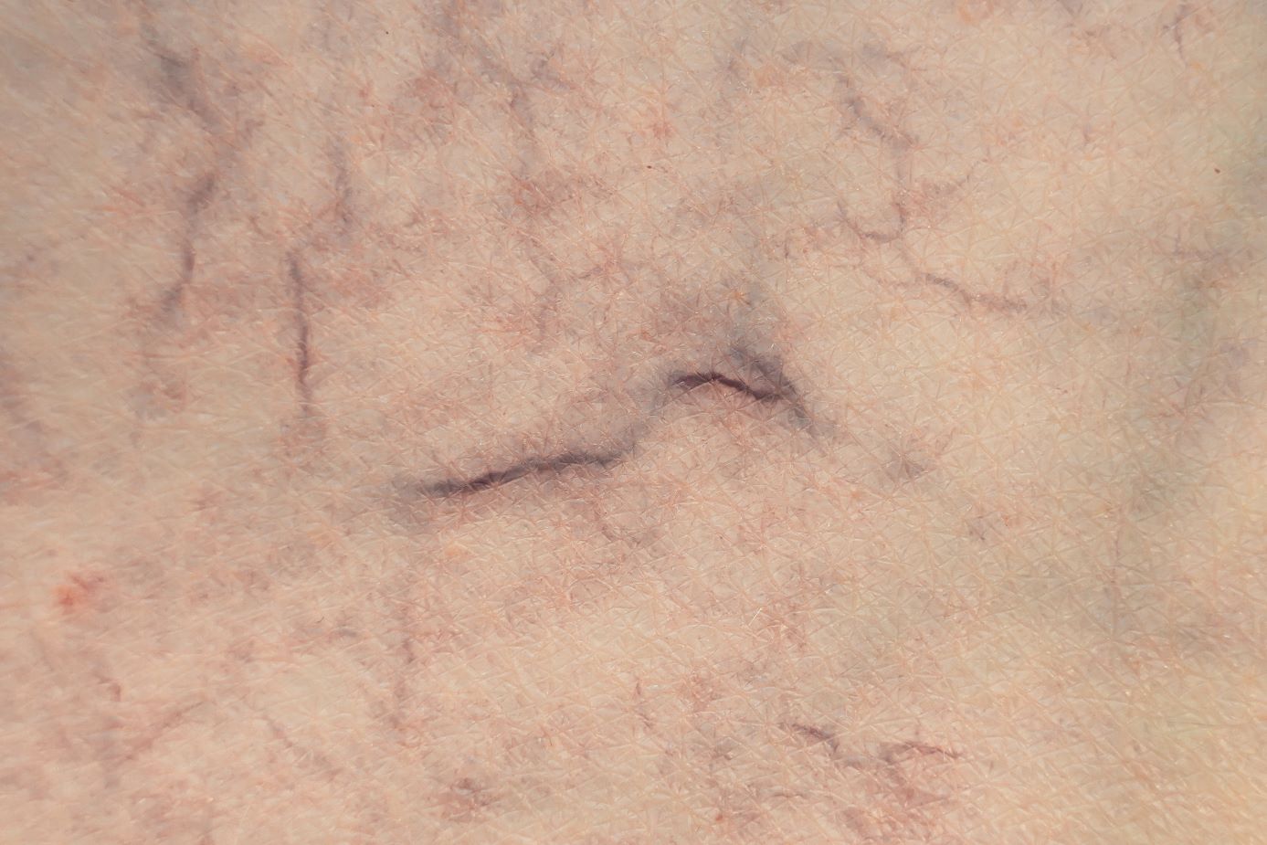 Spider Angiomas - Southlake Dermatology